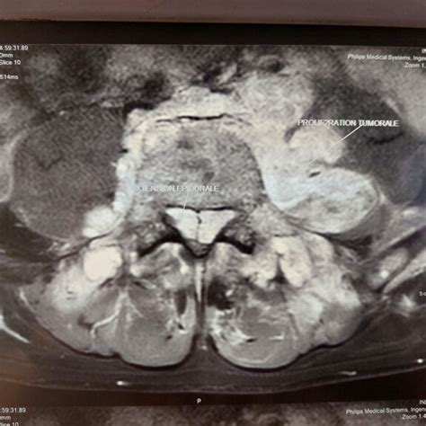 Cross Section Of A Spinal Cord Mri Showing Spinal Cord Compression At
