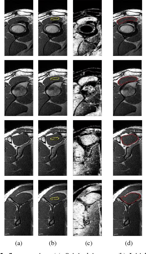 Figure 5 From Active Contour Segmentation Using Level Set Function With Enhanced Image From