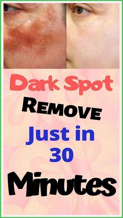 Simple Trick To Remove Brown Spots From Your Skin Check This Out