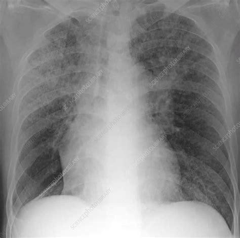 Miliary Nodules X Ray Stock Image F035 6546 Science Photo Library