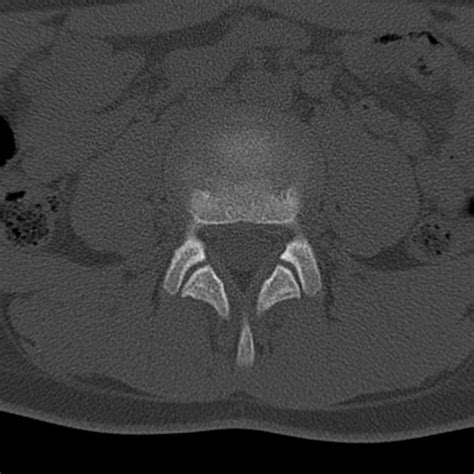 Bilateral Pars Defect Radiopaedia 26691 26846 Axial Bone Window Nc