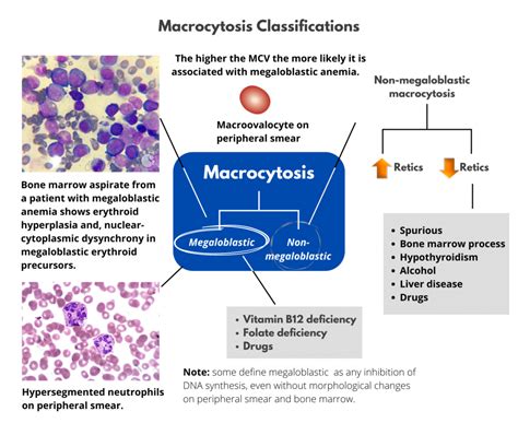 Bone Marrow Diagram Of Megaloblastic Anemia