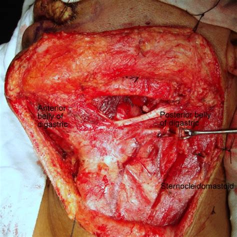 Post Modified Radical Neck Dissection On Left Side Download Scientific Diagram