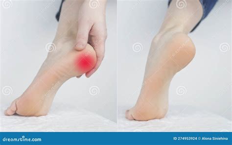 Antes E Depois Mulher Dor No Calcanhar Inflamação Ou Torção Do