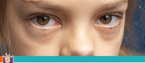 Pediatric Conjunctivitis Pink Eye Treatment Near Me
