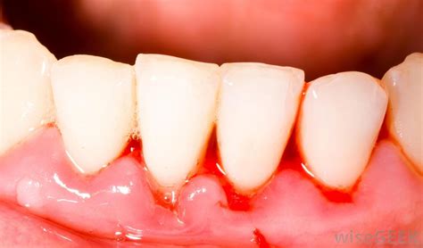 Bleeding While Brushing Your Tooth Could Soon Fall Off TheCable