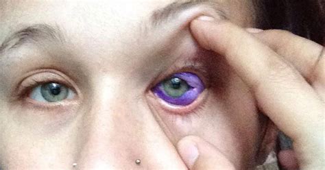 Sclera Tattoo Causes Models Severe Eye Infection Possible Blindness
