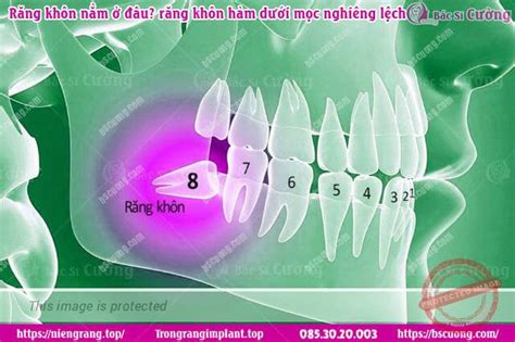 Răng Khôn Là Gì BÍ QuyẾt Biết Răng Số 8 Mọc Khi Nào Tác Dụng Gì