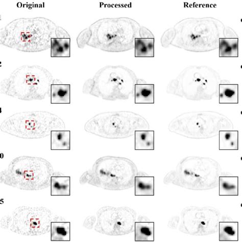 Results Of Ki Parametric Imaging For Patients 1 2 4 10 And 15 Download Scientific