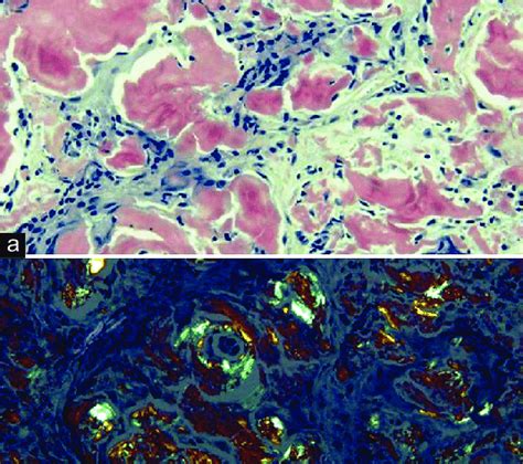 Congo Red Stain The Gold Standard For Diagnosing Amyloidosis