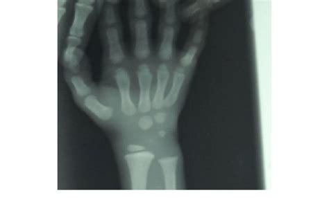 X Ray Wrist Shows Normal Bone Age Download Scientific Diagram