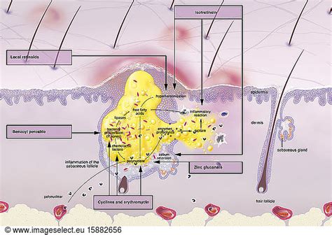 Acne Around The Hair Follicle Acne Around The Hair Follicle Sebaceous