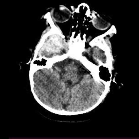Pre Embolization Ct Scan Depicting A Significant Amount Of Blood Clot