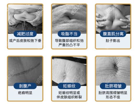 杭州腹部抽脂多少钱杭州做肚子吸脂价格13万腹壁整形4万吸脂对比照 8682整形网