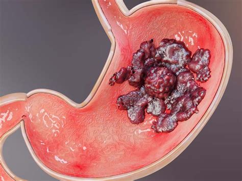 What Are The 5 Most Common Cancers In India World Cancer Day 2024