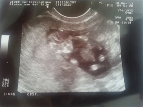 Echo 11 Weken En 1 Dag Brabbels Fotoalbum