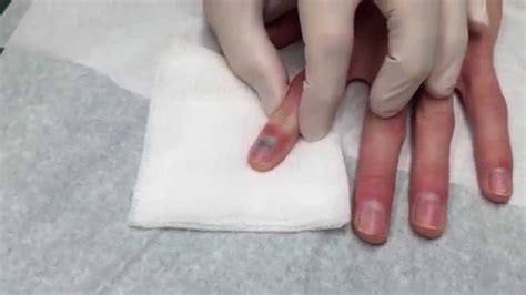 Infected Smashed Finger