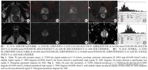 超高b值dwi对外周带前列腺癌的诊断价值 知乎