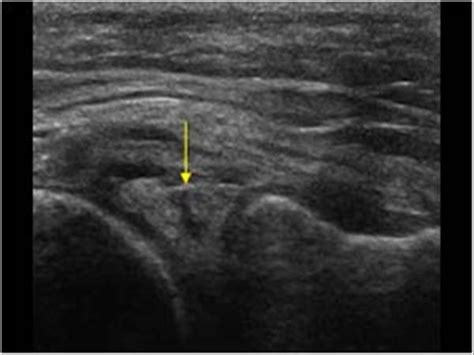 Musculoskeletal Joints And Tendons 66 Knee Case 6614 Meniscus