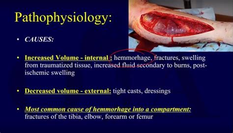 Pathophysiology Of Compartment Syndrome —