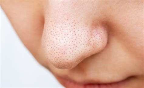 Enlarged Pores Medix Skincare