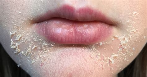 Skin Rash Around Mouth
