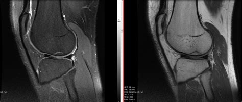 Knee Subchondral Stress Fracture