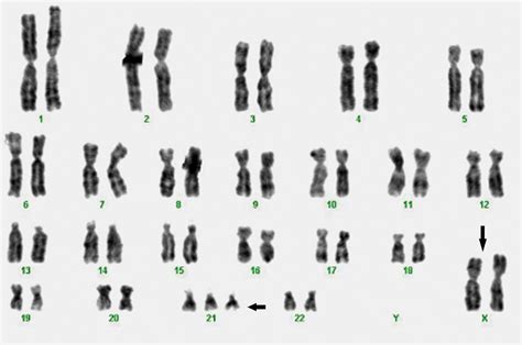 Xx Testicular Disorder Of Sex Development With Down Syndrome