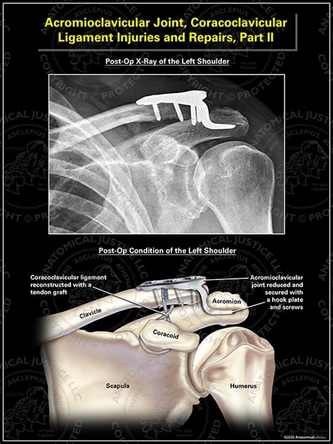 Acromioclavicular Joint Coracoclavicular Ligament Injuries And Repairs