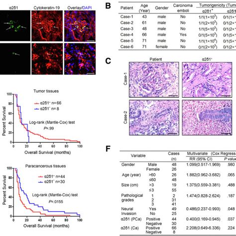Clinical Significance Of A2d1 Expression In Pdac And Paracancerous