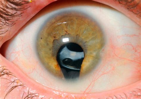 Coloboma Iris