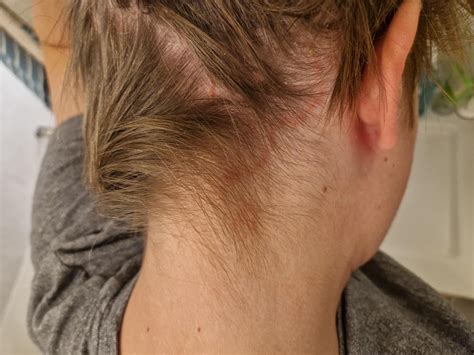 Couls This Be Seb Derm R Sebderm