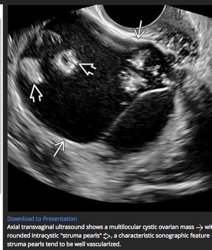 Brenner Tumor Ultrasound