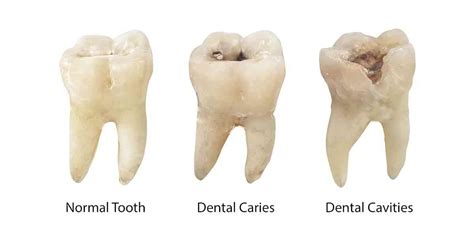 Cavities In Teeth