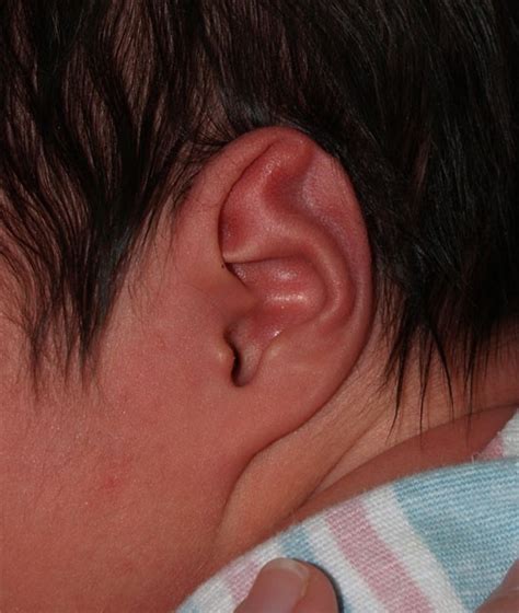 Identifying Ear Abnormality From 2D Photographs Using 56 OFF