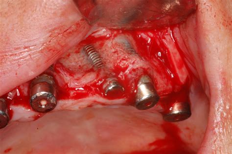 Periodontal Implant Cases By Dr Thomas Kang Maxillary Overdenture