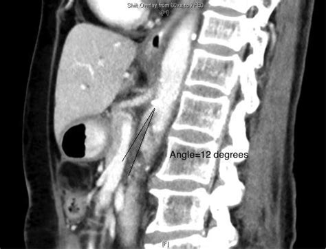 Aortomesenteric Angle In A Patient With Smas Download Scientific Diagram