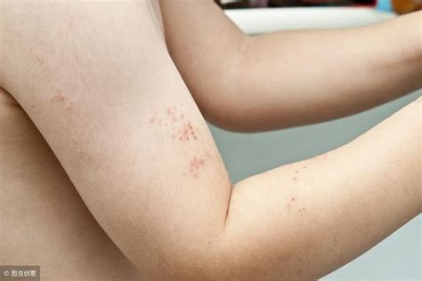 得了带状疱疹会传染人吗？看完涨知识了 每日头条