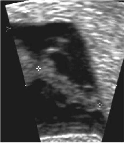 What Are Vocal Cord Cysts Isaac Namdar Md