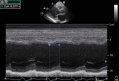 Strategies And Pacemaker Algorithms For Avoidance Of Unnecessary Right