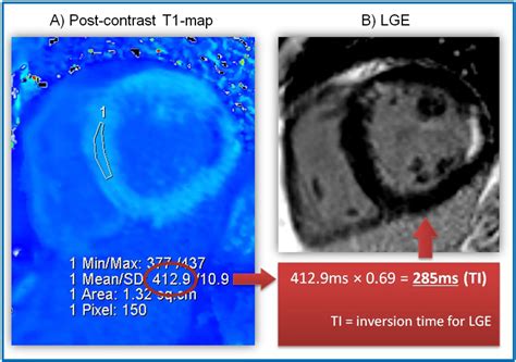 Post Contrast T1 Mapping Provides A Novel Approach To Optimal Myocardial Nulling For Late
