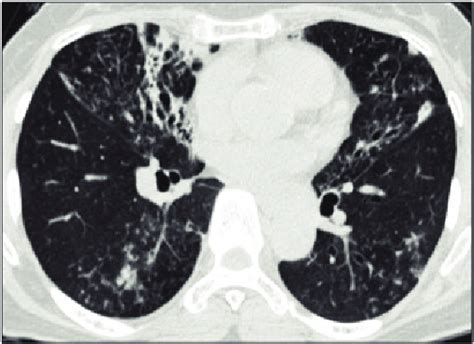 Ct Of Nodular Bronchiectatic Form Of M Intracellulare Pulmonary