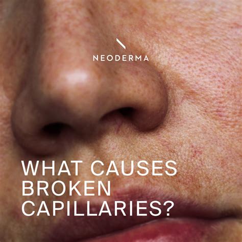 What Causes Broken Capillaries Neoderma