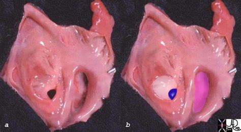 The Left Atrium The Common Vein