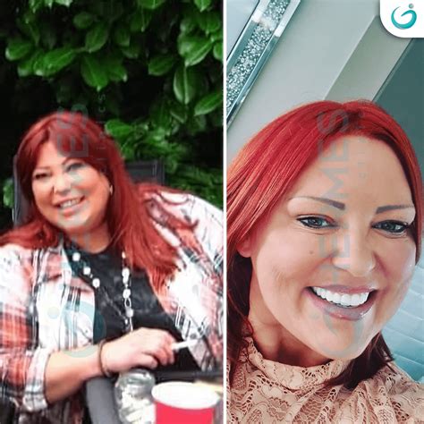 Before And After Hermes Clinics