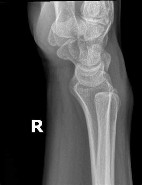 Orthodx Wrist Pain On Ulnar Side Clinical Advisor