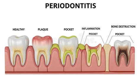 Stages Of Periodontitis Illustrated By Different Tooth Conditions Stock