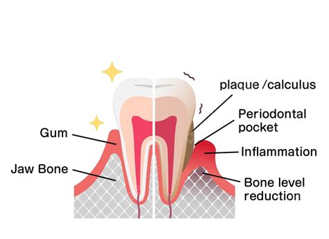 Flat Vector Illustration A Comparison Between Healthy Teeth And