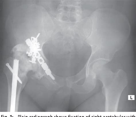 Pdf Migration Of A Broken Drill Bit After Acetabular Fracture