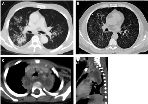 Imaging Findings In Pulmonary Tb A Ill Defined Parenchymal Opacity